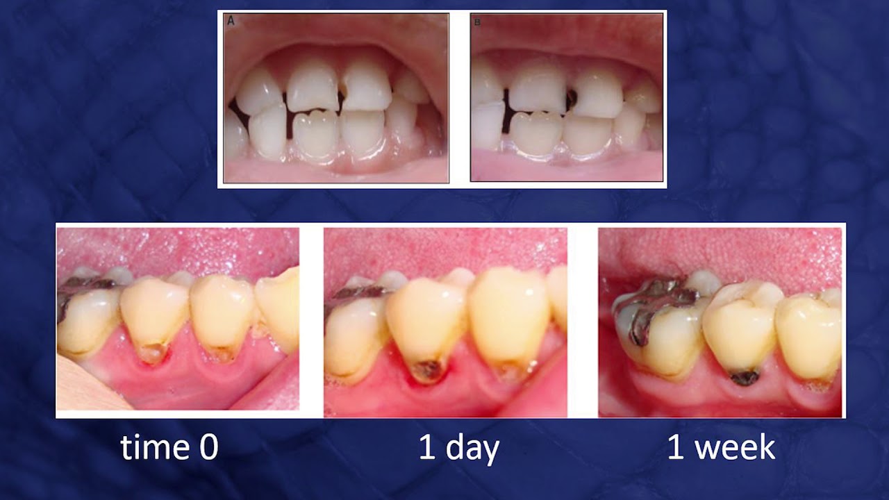 Fighting Cavities Without A Dentist Drill - Ivanhoe Broadcast News, Inc.
