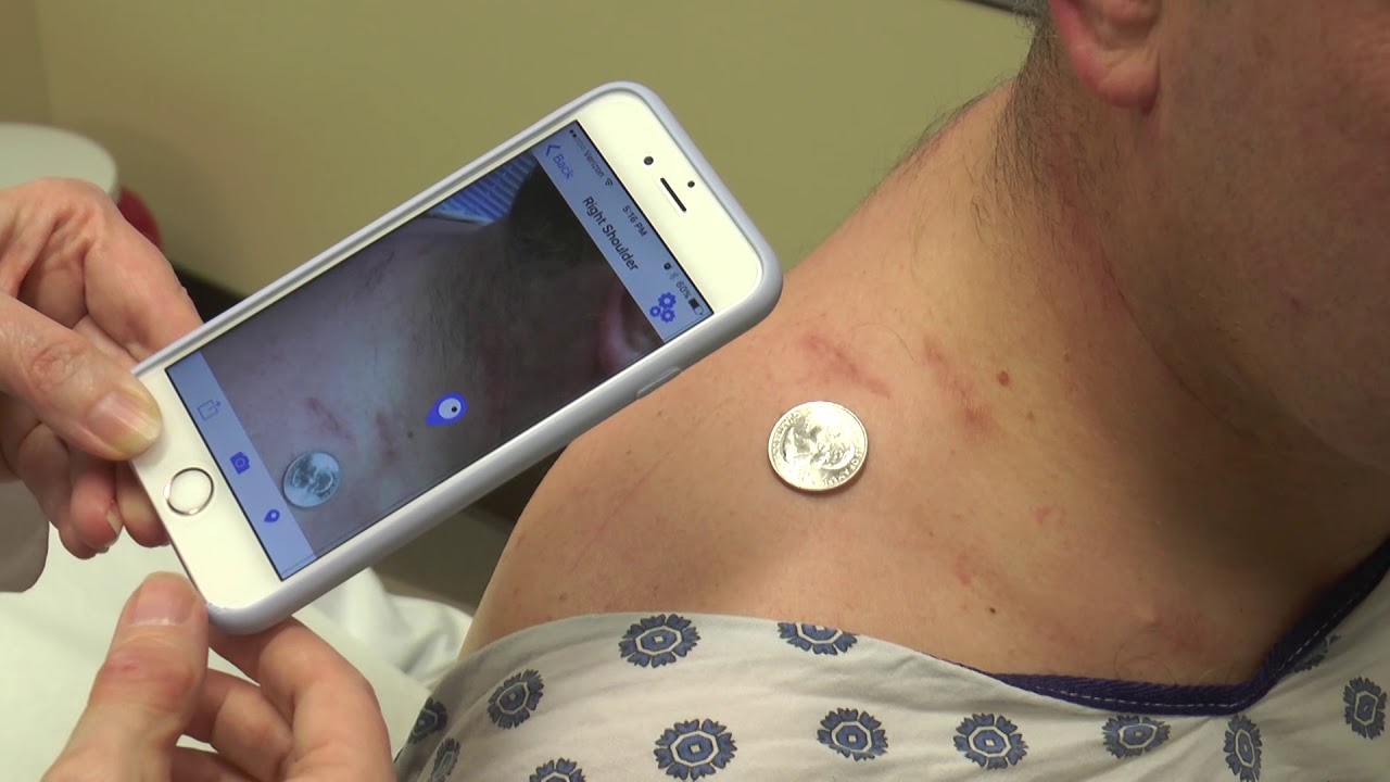 Mole Mapper App Tracks Cancer - Ivanhoe Broadcast News, Inc.