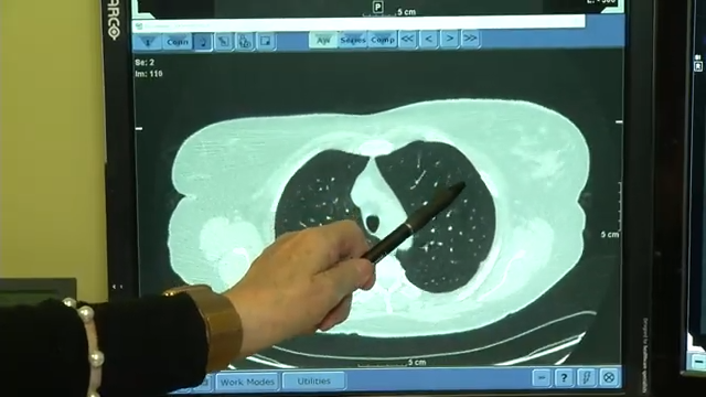 Secret Signs of Cancer - Ivanhoe Broadcast News, Inc.