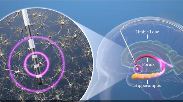 Brain Stimulation: Shocking Benefits - Ivanhoe Broadcast News, Inc.