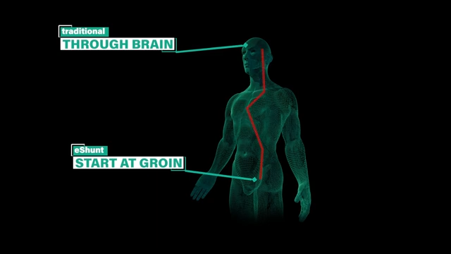 Minimally Invasive Surgery for NPH - Ivanhoe Broadcast News, Inc.