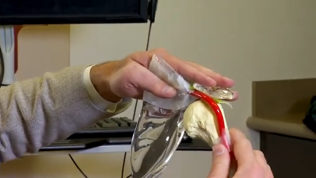 Balloon Spacers Rescue Rotator Cuffs - Ivanhoe Broadcast News, Inc.