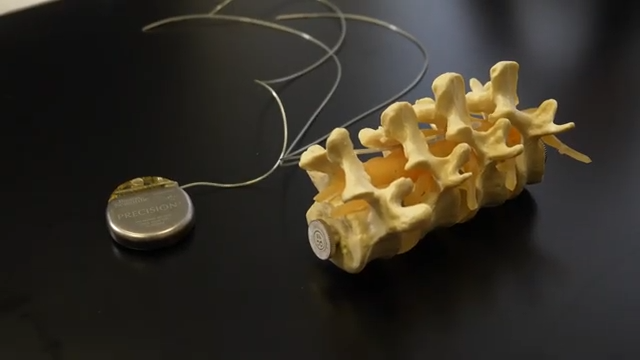 Pill-less Pain Relief: Neurostimulators Replacing Opioids - Ivanhoe ...