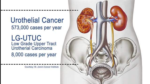 Non-Surgical Breakthrough for Rare Urinary Tract Cancer - Ivanhoe ...