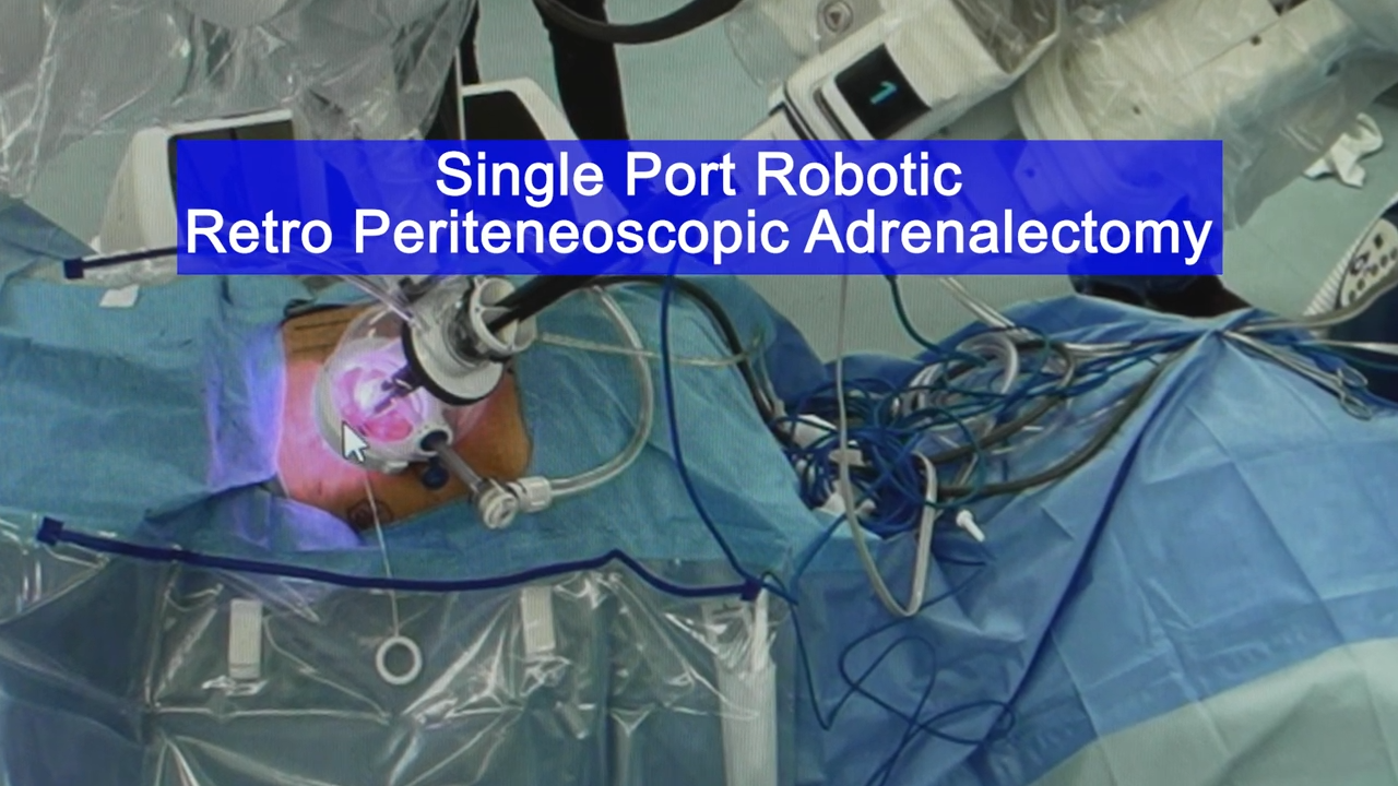 Adrenal Robotic Surgery is a Game Changer - Ivanhoe Broadcast News, Inc.