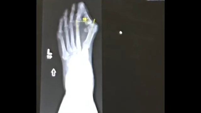 Breakthrough Bunion Procedure - Ivanhoe Broadcast News, Inc.