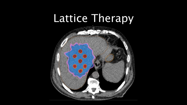 Blasting Away Tumors With Lattice Therapy Ivanhoe Broadcast News Inc